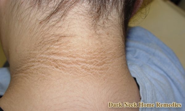 24 Home Remedies for Dark Neck - Home Remedies