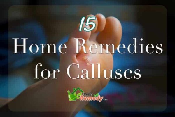 15 Home Remedies for Calluses and Corns that Work Quickly - Home Remedies