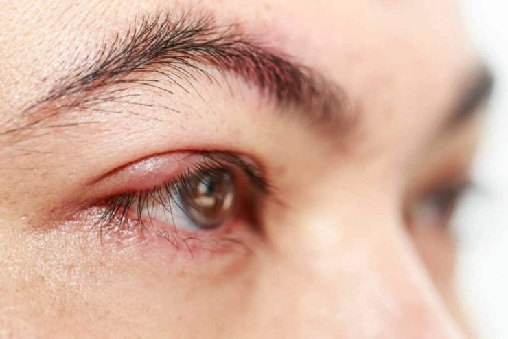 9 Home Remedies for Blepharitis (Eye Inflammation) - Home Remedies