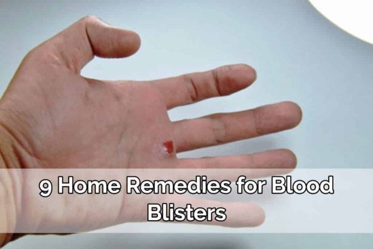 9 Home Remedies for Blood Blisters - Home Remedies