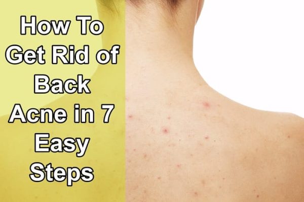 Treat Back Acne at Home